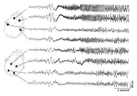 10 Best Images About Tonic Clonic Grand Mal Seizure On Pinterest