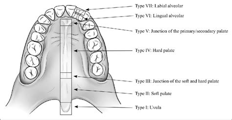 The Pittsburgh Fistula Classification System According To Smith Et Al Download Scientific