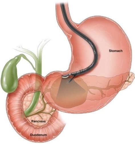 Cholangioscopy Medigest Medium