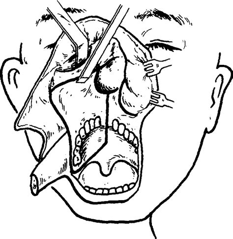 29 保留眶底的上颌骨次全切除术 耳鼻咽喉科手术