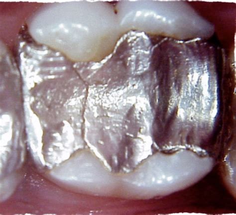 Amalgam And Alloy Flashcards Quizlet