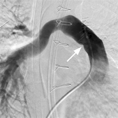 Selective Digital Subtraction Pulmonary Arteriogram Demonstrating A