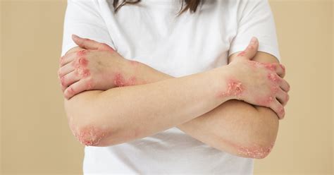 Hives Sings Triggers Treatments Optimists Wellness India