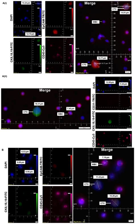 Standardization And Validation Of Ctc By If×3 Using Breast Ovarian