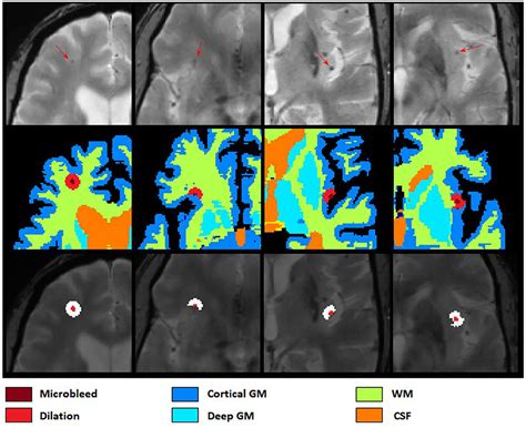 Frontiers Using Transfer Learning For Automated Microbleed Segmentation