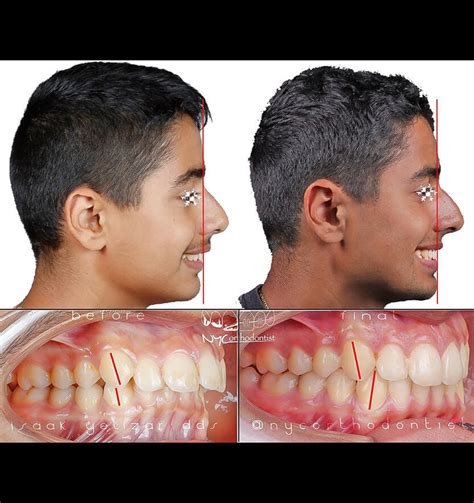 Overbite Before And After Side View Orthognathic Jaw Surgery Before