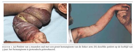 Hemangiomen En Congenitale Vasculaire Malformaties Classificatie En