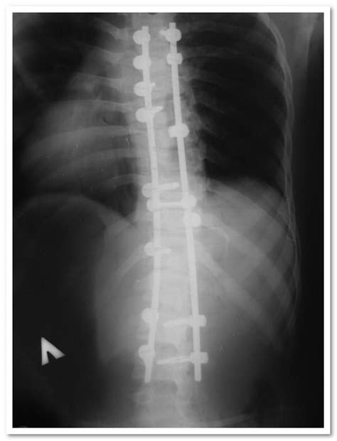 Сколиоз 4 степени особенности лечение