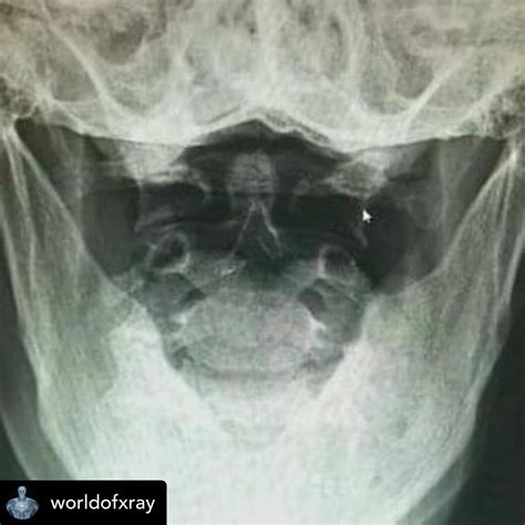 World Of X Ray On Instagram “awesome Odontoid From 🙆 • 📸 Lshorty2012 Repost • • Radtech