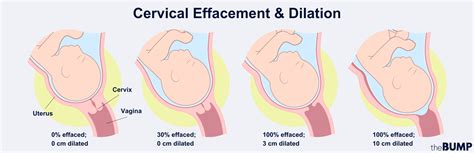 Checking Cervix Effacement Dilation