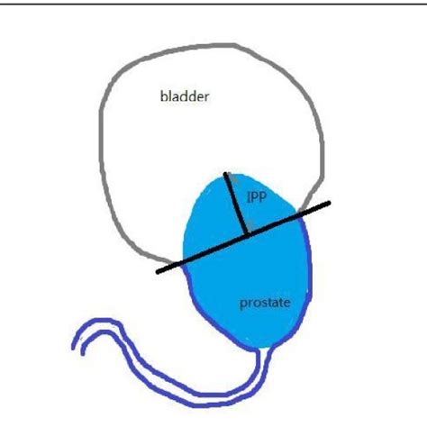 Measurement Of Intravesical Protruding Prostate In Sagittal Plane Of
