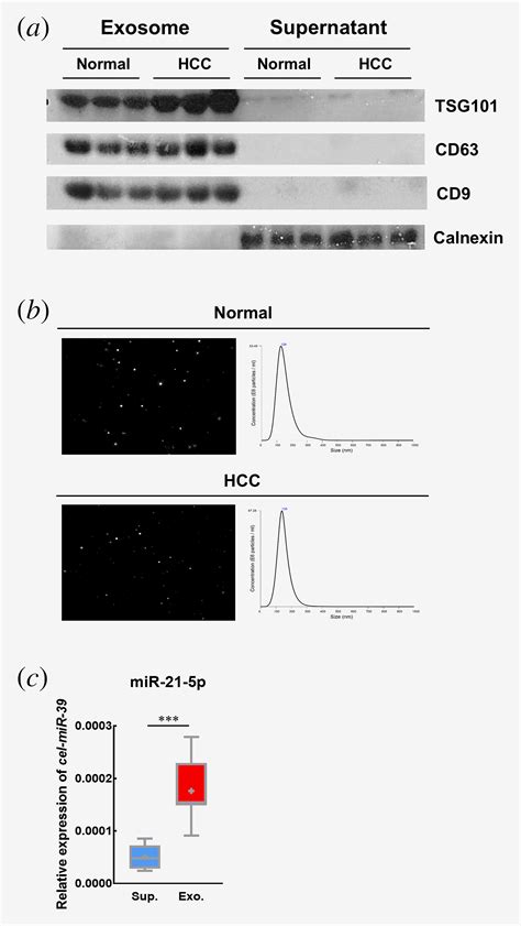 Circulating Exosomal Noncoding RNAs As Prognostic Biomarkers In Human Hepatocellular Carcinoma
