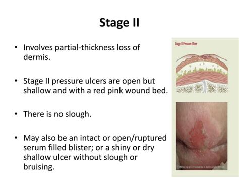 Pressure Ulcers A Decubitus Ulcer Stages Of Bedsore Ppt