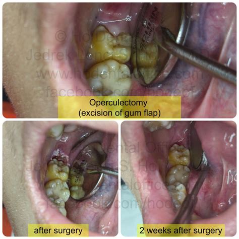 Operculectomy Dental Circumcision Ho Dental Office Dentist