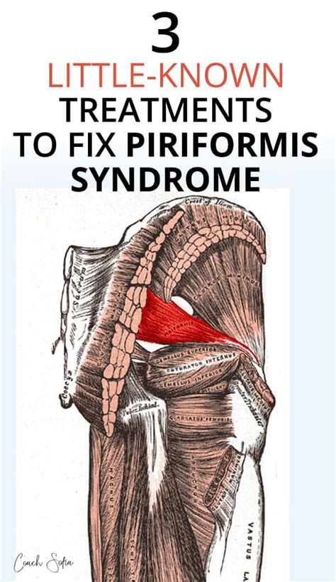 How To Heal Piriformis Syndrome When Youve Tried Everything Else