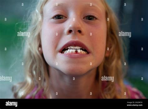A Young Girl Proudly Shows Off Her Mouth And The Gap In Her Teeth Where