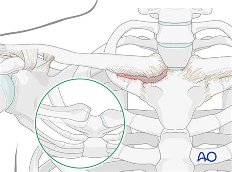 Reduction Of Sternoclavicular Dislocation For Medial Articular