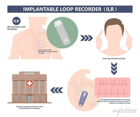 Loop Holter Event Atrial Heart Attack Stroke Ecg Ekg Device Monitoring