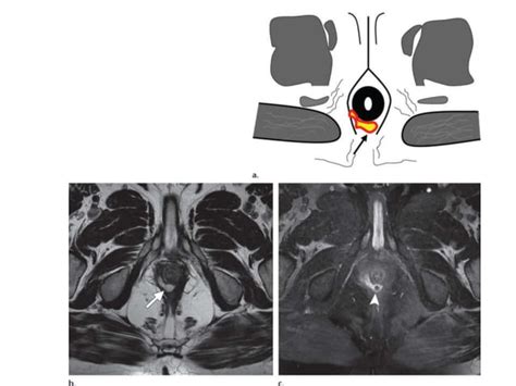 Peri Anal Fistula Mri