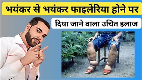 हाथीपांव हो जाने पर दिया जाने वाला इलाज Filaria Treatmemt In Hindi