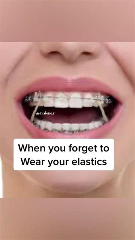 When You Forget To Wear Your Elastics Getting Braces Sensitive Teeth