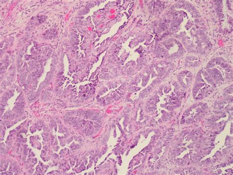 A Case Of Non Hpv Related Primary Endometrioid Adenocarcinoma Of The Cervix Pmc