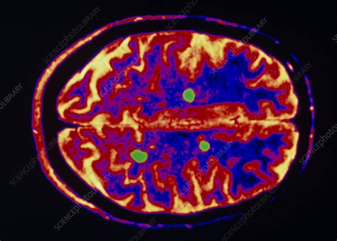 Col Mri Brain Scan Of A Multiple Sclerosis Patient Stock Image M210