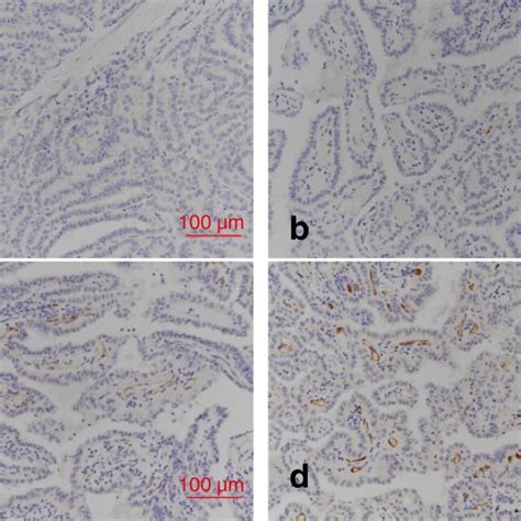 Prostate Specific Membrane Antigen Expression In Normal Thyroid Left