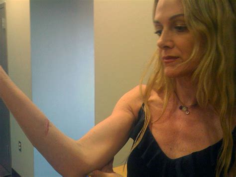 Skin Cancer Survivor Launches Campaign To Teach Teens Wtop News