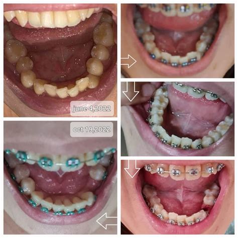 5th Month Today Power Braces For The First Time Rbraces