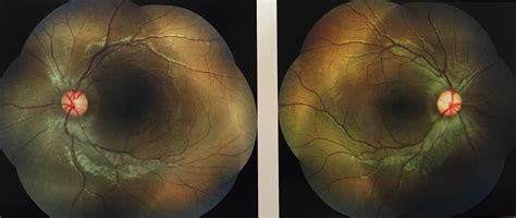 Indian Arsacs Autosomal Recessive Spastic Ataxia Of Charlevoix