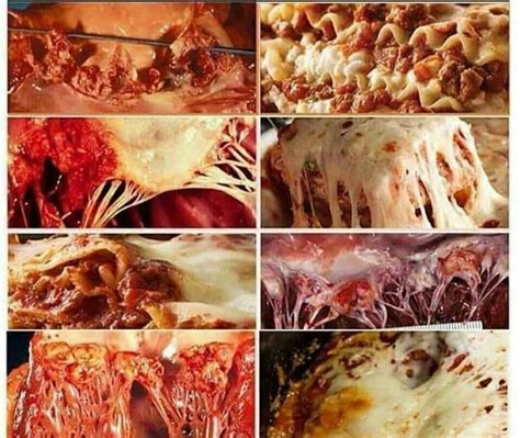Lasagna Or Endocharditis 9gag