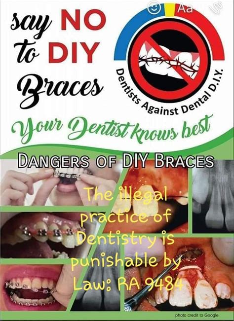 Say No To Diy Braces👍 The Angel Js Smile Dental Clinic