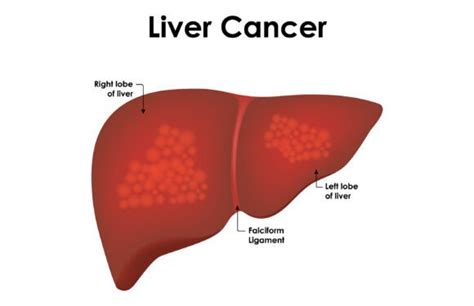 Liver Cancer Anatomy Right And Left Lobe Graphic By As Ashik · Creative
