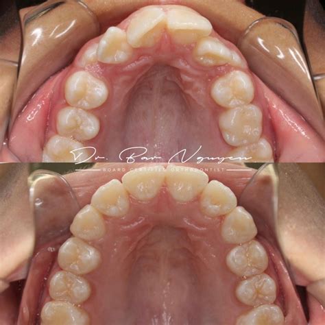 Dr Bar The Braces Doc On Linkedin Arch Development Non Extraction 🔥👌