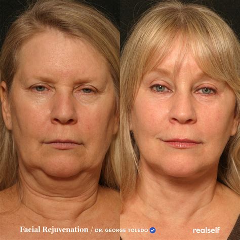 Jowls Sagging Skin Face Jowl Face Firming