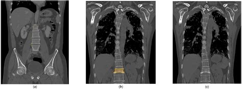 Opportunistic Screening For Acute Vertebral Fractures On A Routine Abdominal Or Chest Computed