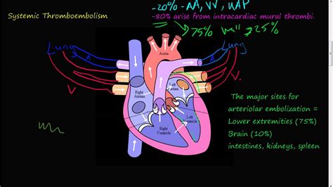 Mural Thrombus