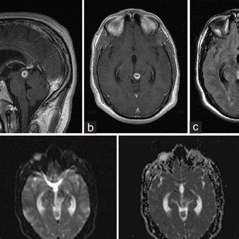 Initial Mri Showing Tectal Ring Enhancing Mass A Sagittal T1 With
