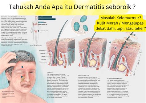 Dermatitis Seboroik Klinik Bersatu Sungai Nibong 中文