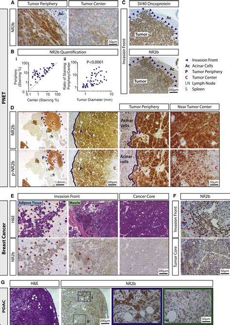Hijacking The Neuronal NMDAR Signaling Circuit To Promote Tumor Growth