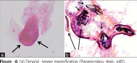 Figure 1 From Female Genital Schistosomiasis Fgs As A Risk Factor For
