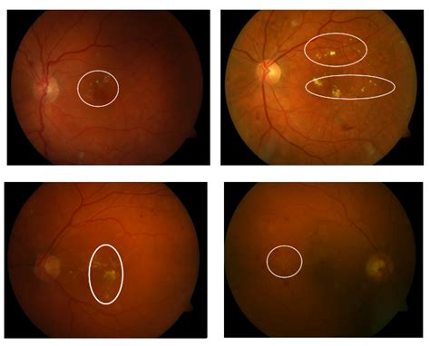 Sample Retinal Images Showing Hard Exudates Enclosed In White Circles