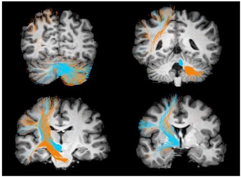 In Vivo Cerebro Cerebellar Loop Diffusion Tractography Can Be Used To
