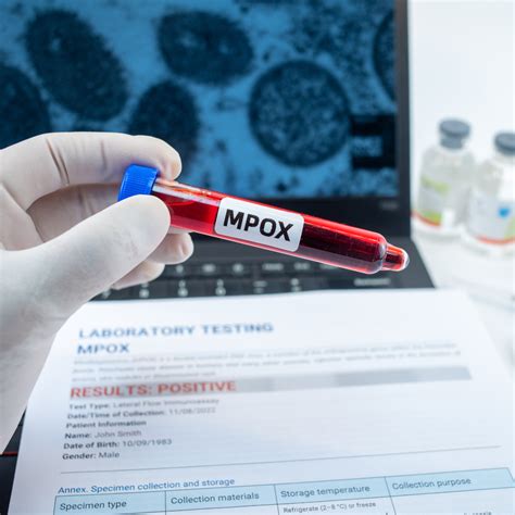 Asia Ramps Up Border Controls Tests And Vaccines As New Clade Of Mpox