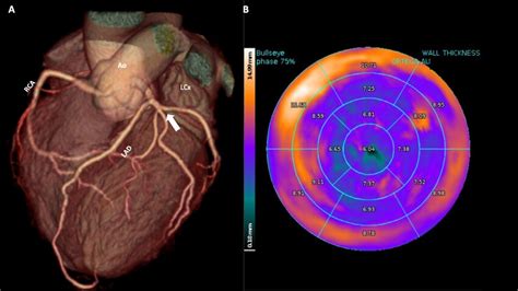 A Cardiac Computed Tomography Angiography Demonstrated An Anomalous Download Scientific
