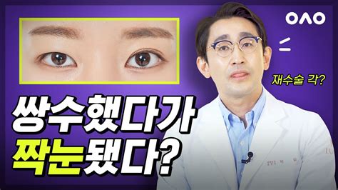 [짝눈 재수술] 쌍수했는데 짝눈이 됐다 짝눈 재수술 교정의 모든것 알려드려요 Youtube