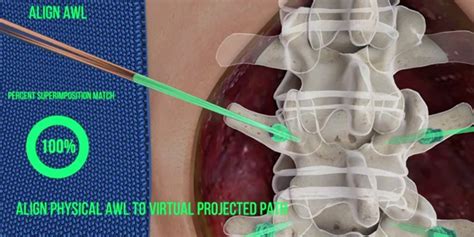 Fda Clears Novel Augmented Reality Spine System Orthopedics This Week