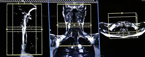 Magnetic Resonance Angiography Mra Neck Dissection Protocols And