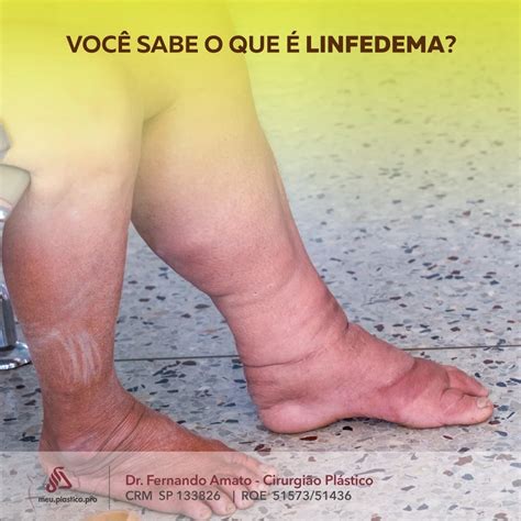 O que é o Lipedema